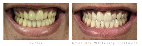 Why Teeth Whitening Is Best Done At The Dentist
