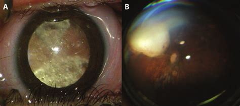 Red Fundus Reflex Loss And Peripheral Posterior Subcapsular Cataract