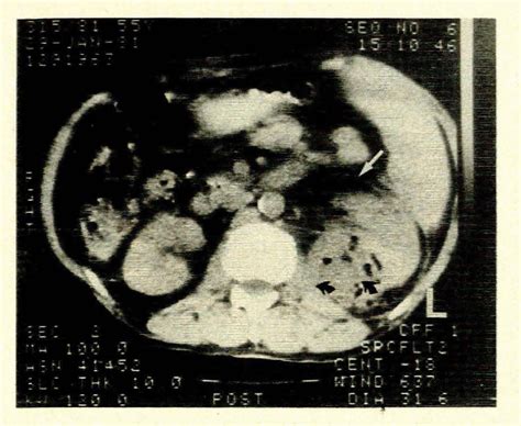 Figure 1 From Computed Tomography Of Intra­ Abdominal Abscesses Semantic Scholar