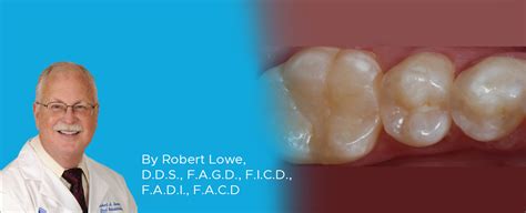 Optimizing Aesthetics And Predictability In The Placement Of Posterior Composite Resin