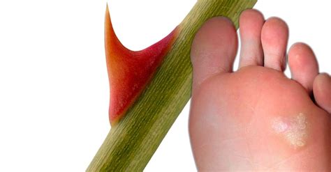 Что такое шипица и как ее лечить МЦ Лазерсвiт