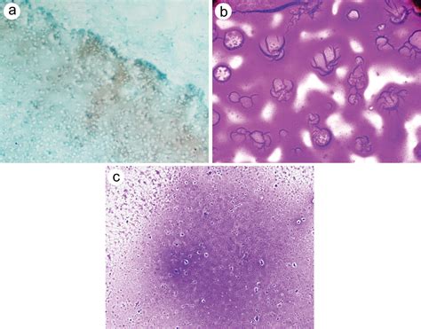 Bethesda System For Reporting Thyroid Cytopathologyan Updated Review