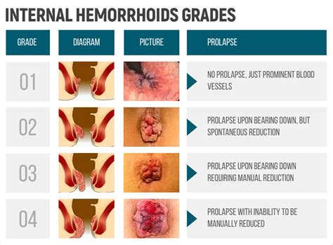 Hemorrhoids Doctor Nyc Hemorrhoid Treatment Specialist New York