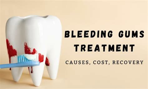 Bleeding Gums Treatment Causes Cost Recovery Richardsons Plastic Surgery Hospitals