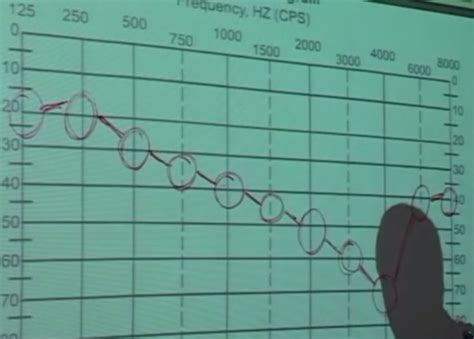 Understanding And Interpreting The Audiogram Flashcards Quizlet