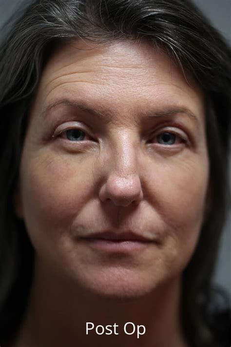 Upper Blepharoplasty 8982