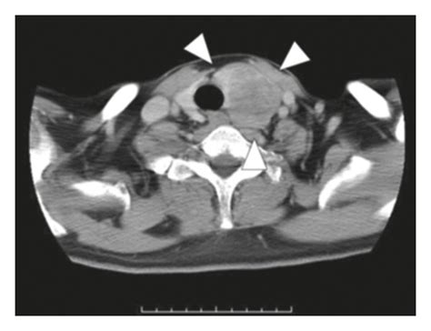 Imaging Studies Before The Thyroidectomy Contrast Enhanced Ct Showed A