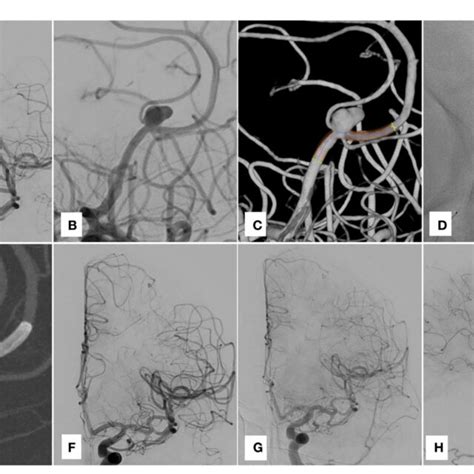 FIGURE Case E A C Pre Treatment DSA And DD Reconstruction D Download Scientific Diagram