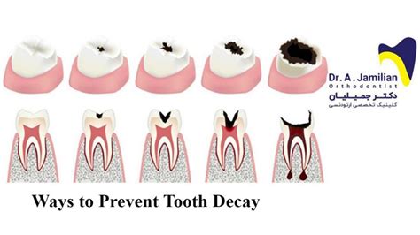 Ways To Prevent Tooth Decay Dr Jamilian