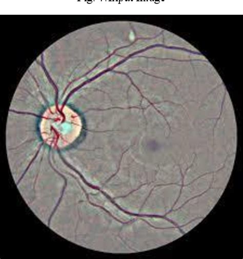 Figure 8 From Deep Learning Approaches For Detecting Diabetic Retinopathy Using Cnn Models