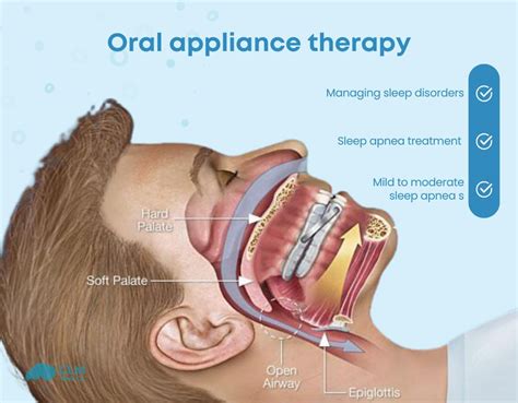 Oral Appliance Therapy A Non Invasive Solution For Sleep Apnea