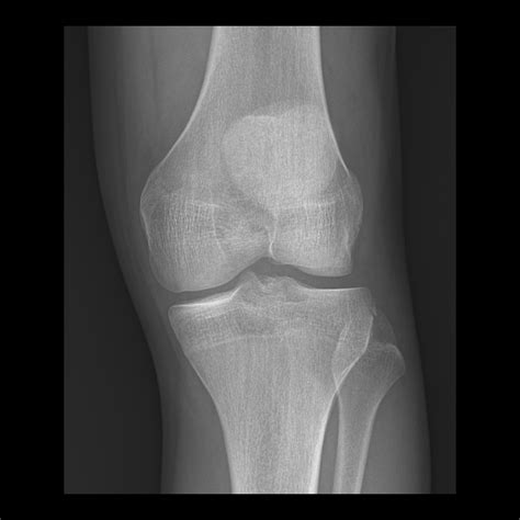 Segond Fracture Pediatric Radiology Reference Article Pediatric