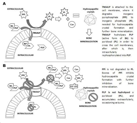 Hypophosphatasia Clinical Assessment And Management In The Adult