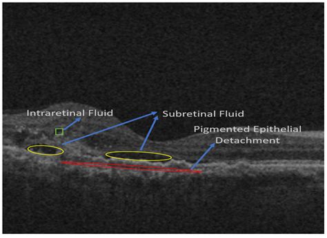 Various Pathologies Of Interest That Are Observed In Oct Images Irf Download Scientific