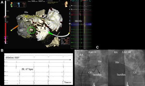 Peak Frequency Annotation Algorithm Guided Slow Pathway Ablation In