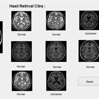The Image Retrieval Results With Query Image Of Normal By Using