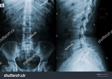 Film Xray Lumbar Spine Ls Spine Stock Photo Shutterstock