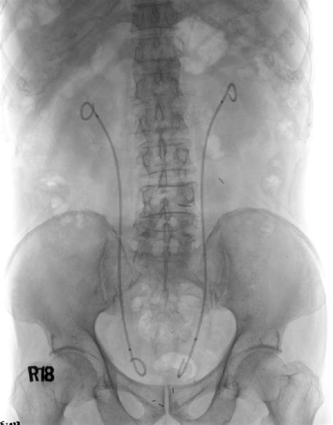 The Ureteral Tumor Stents Bard ® Angiomed Urosoft In A Plain Film