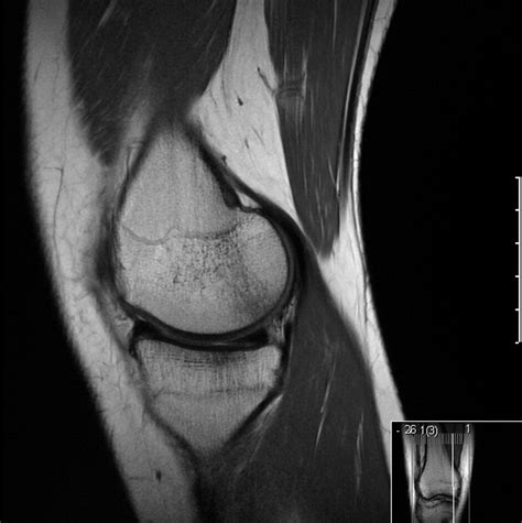 References In Small Medial Meniscocapsular Separations A Potential Cause Of Chronic Medial Side