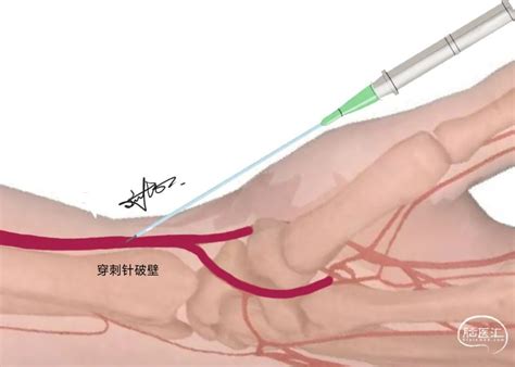 【神介手绘】桡动脉穿刺过程 脑医汇