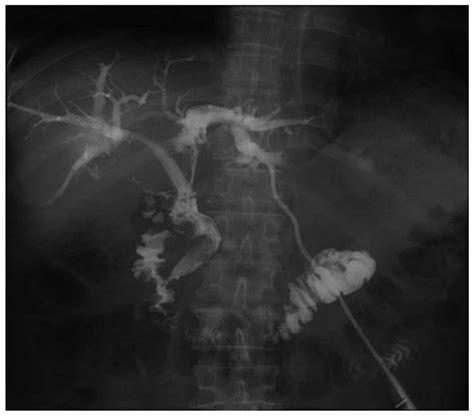 Percutaneous Biliary Stenting Combined With Radiotherapy As A Treatment