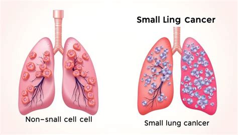 Non Small Cell Lung Cancer Vs Small Cell Key Facts Careyourlungs