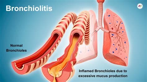 Bronchiolitis Vs Bronchitis