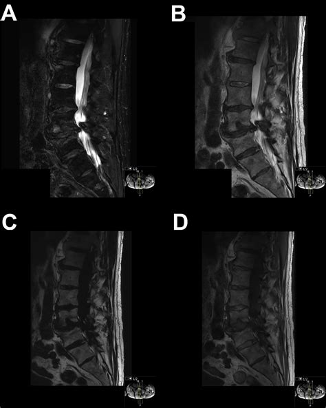 Imaging Of The Degenerative Spine Using A Sagittal T2 Weighted Dixon Turbo Spin Echo Sequence