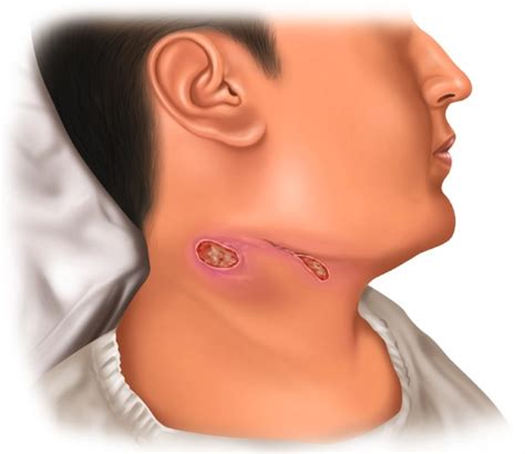 Lymph Node Biopsy Excision Medikeri