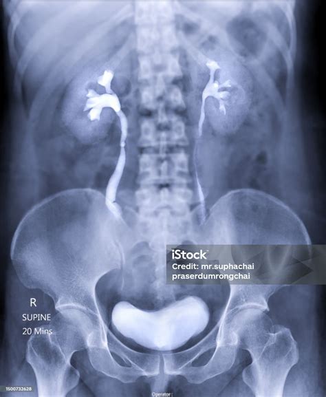 Intravenous Pyelogram Or Ivp Is An Xray Exam Of Urinary Tract After