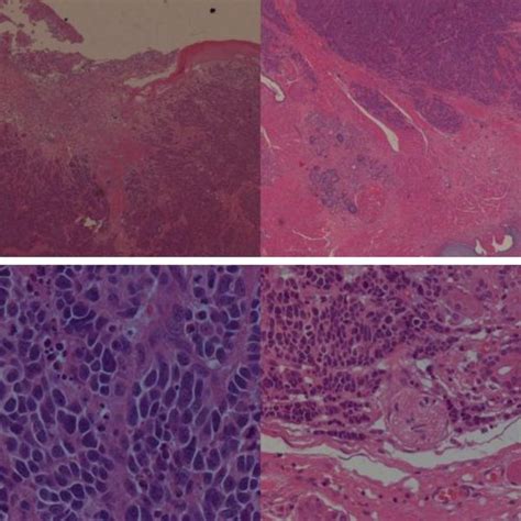 Ct Showing A Primary Tumour In The Right Glossotonsillar Sulcus Black Download Scientific