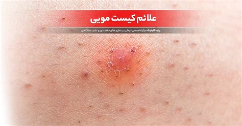آشنایی با انواع علائم کیست مویی پارما کلینیک