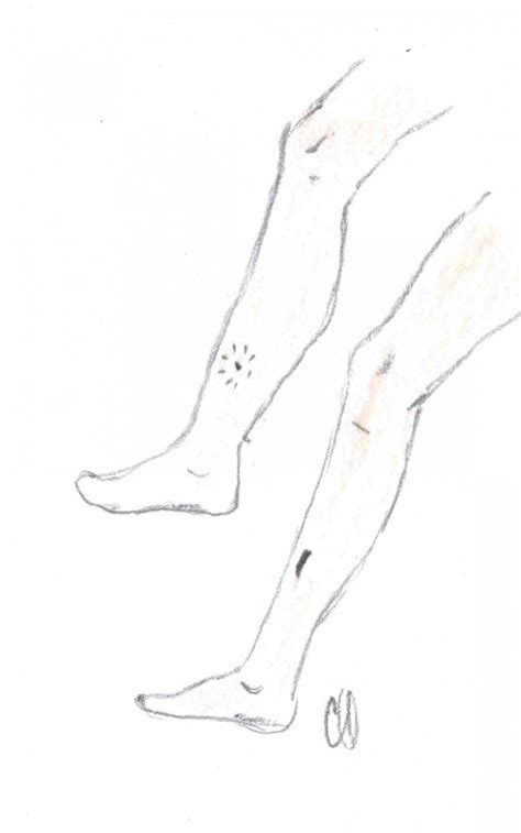 Open Fractures Gustilo Anderson Classification