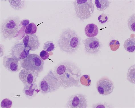 Eosinophil Archives Eclinpath