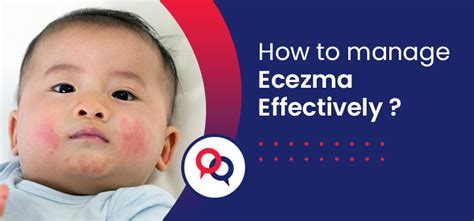 How To Manage Eczema Permanently Second Opinion