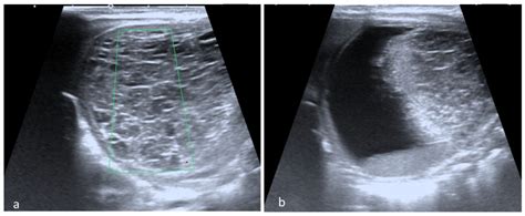 Dermoid Ovarian Cyst Ultrasound
