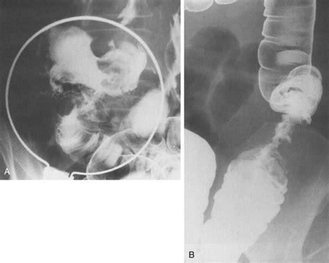 Polyps And Colon Cancer Radiology Key