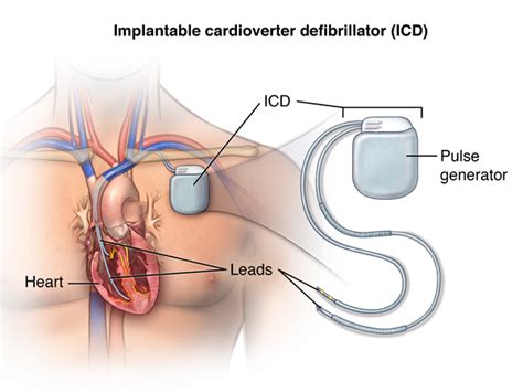 Implantable Cardioverter Defibrillator Circuit Diagram