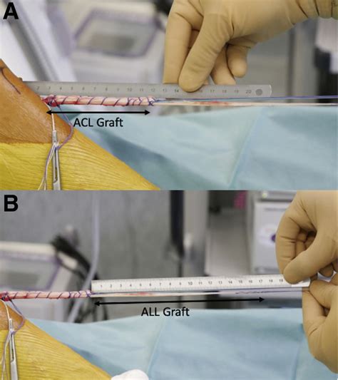 Anterior Cruciate Ligament Acl Graft And Anterolateral Ligament All Download Scientific