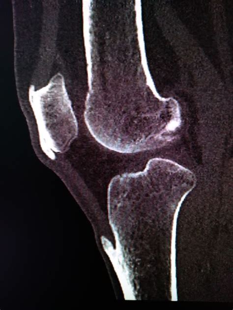 Ossified Patellar And Tibial Tuberosity Enthesopathy