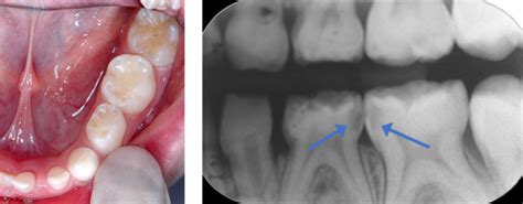 Radiographic Assessment Prevention And Management Of Dental Caries In