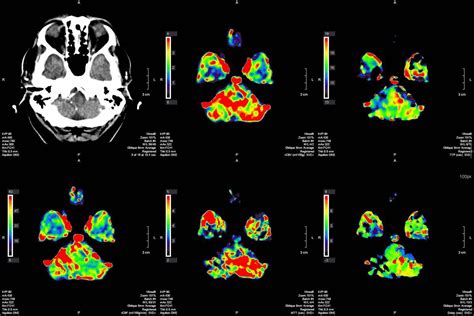 Ct Angiography Acute Stroke Rad Ct Guide