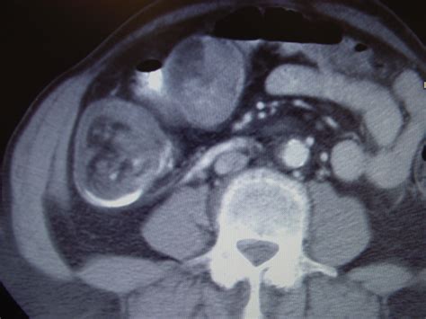 Intussusception Surgery Photos