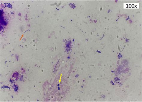 Gram Positive Cocci In Pairs
