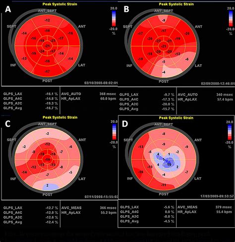 Cvt Mohd Farid 2d Echocardiography Case Review Apical Hcm Discussion In World Journal Of