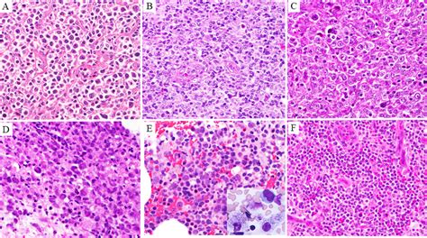 A Diffuse Invasion By Large Atypical Lymphocytes In Nodal Cd4 Tfh