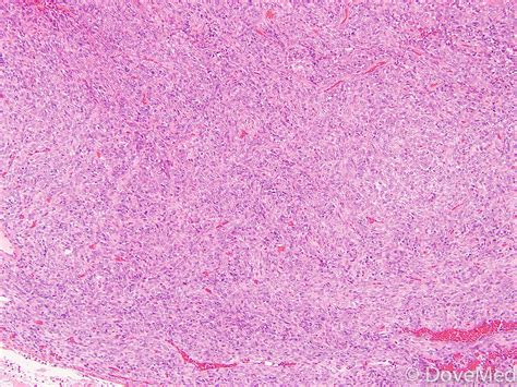 Solitary Fibrous Tumor Solitary Fibrous Tumor