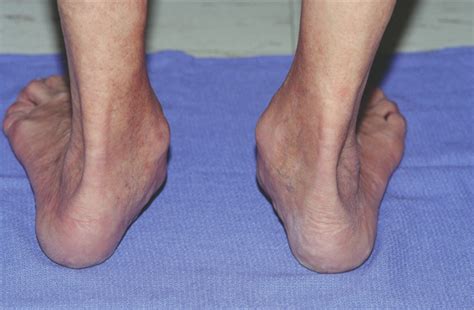Posterior Tibialis Tendon Dysfunction Pttd Adult Acquired Flat Foot Kintec