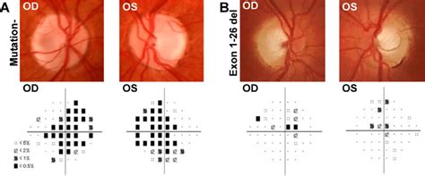 Optic Disc And Humphrey Visual Field Deviations In Patients With And