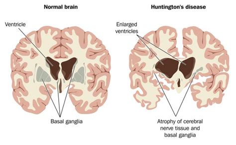 Brain Atrophy Can It Be Reversed University Health News